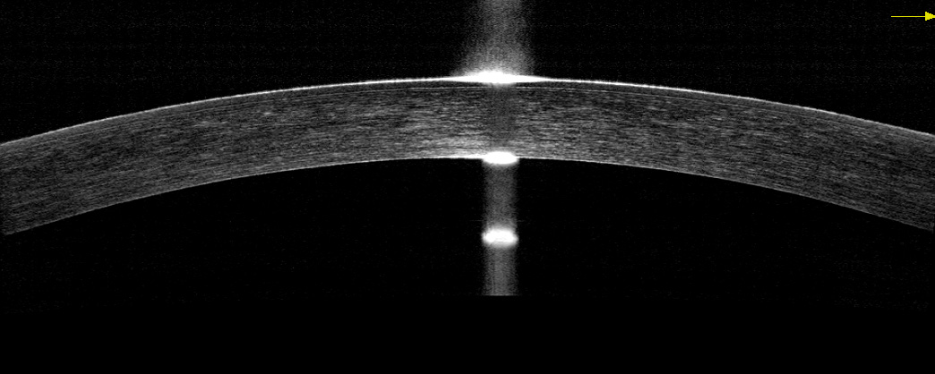 OCT | Clínica Oftalmológica Dra. Sara González | Gijón